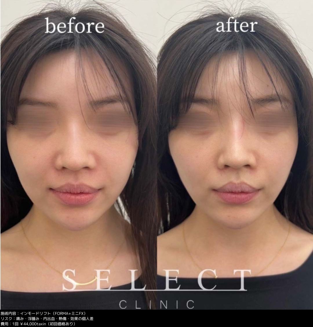 小顔になる方法｜セルフケアから美容施術まで幅広く紹介！│SELECT CLINIC TIPS